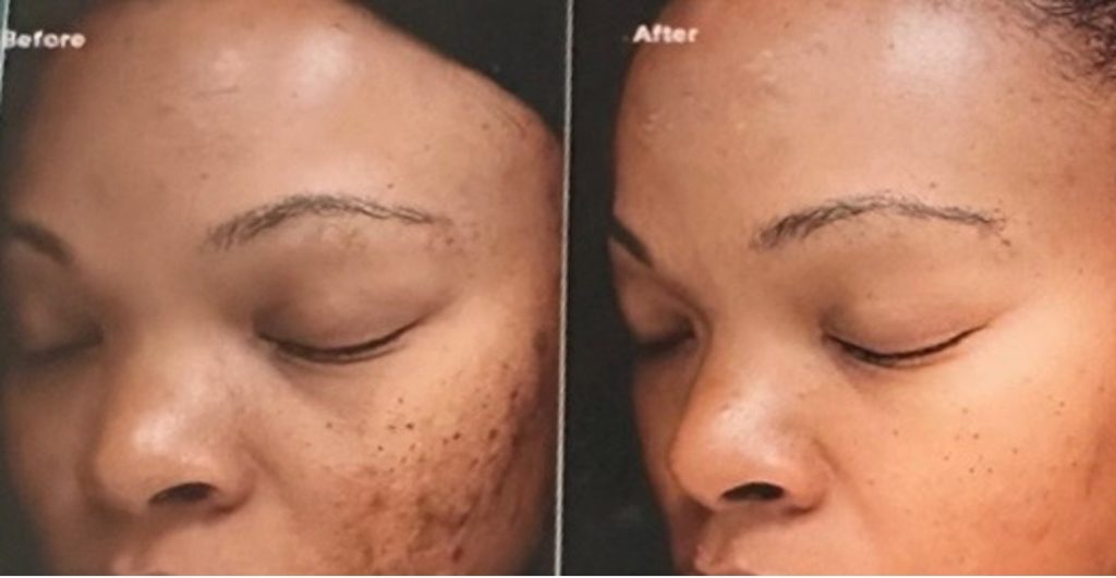 Acne in Patients with Skin of Color: Medical & Procedural Treatment ...