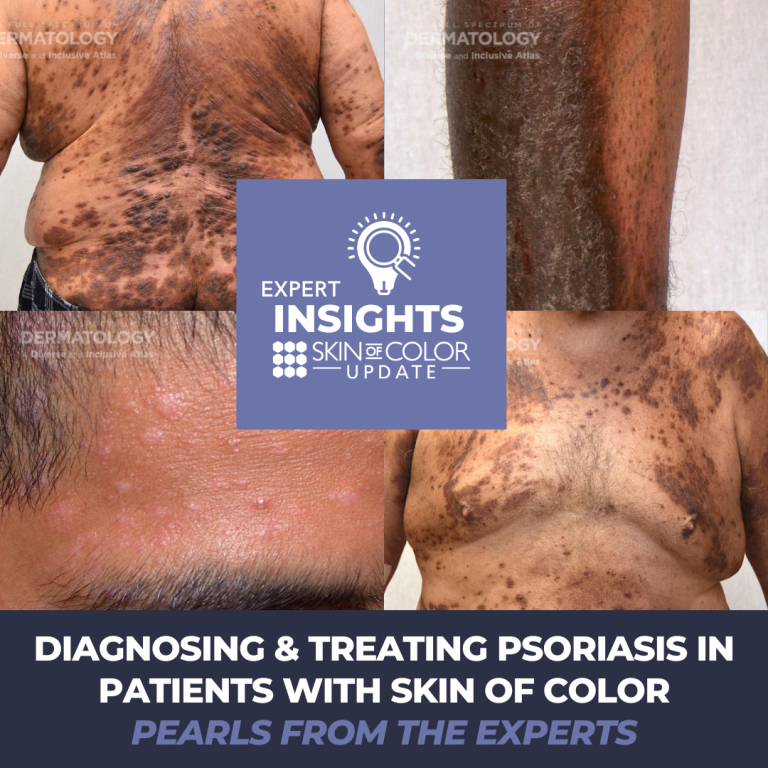 Diagnosing & Treating Psoriasis in Patients with Skin of Color | Pearls ...