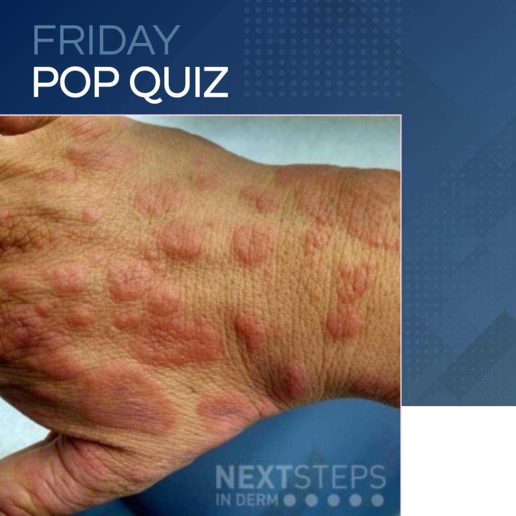 Skin Lesions - Friday Pop Quiz 7/12/2024 - Next Steps in Dermatology