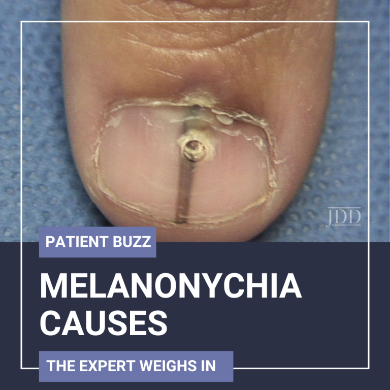 Patient Buzz: Melanonychia Causes | The Expert Weighs In - Next Steps ...