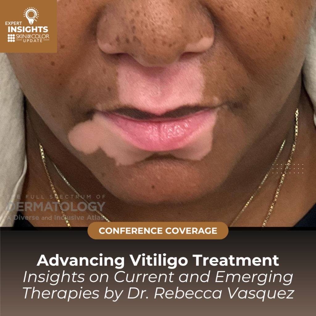 Advancing Vitiligo Treatment: Insights on Current and Emerging ...