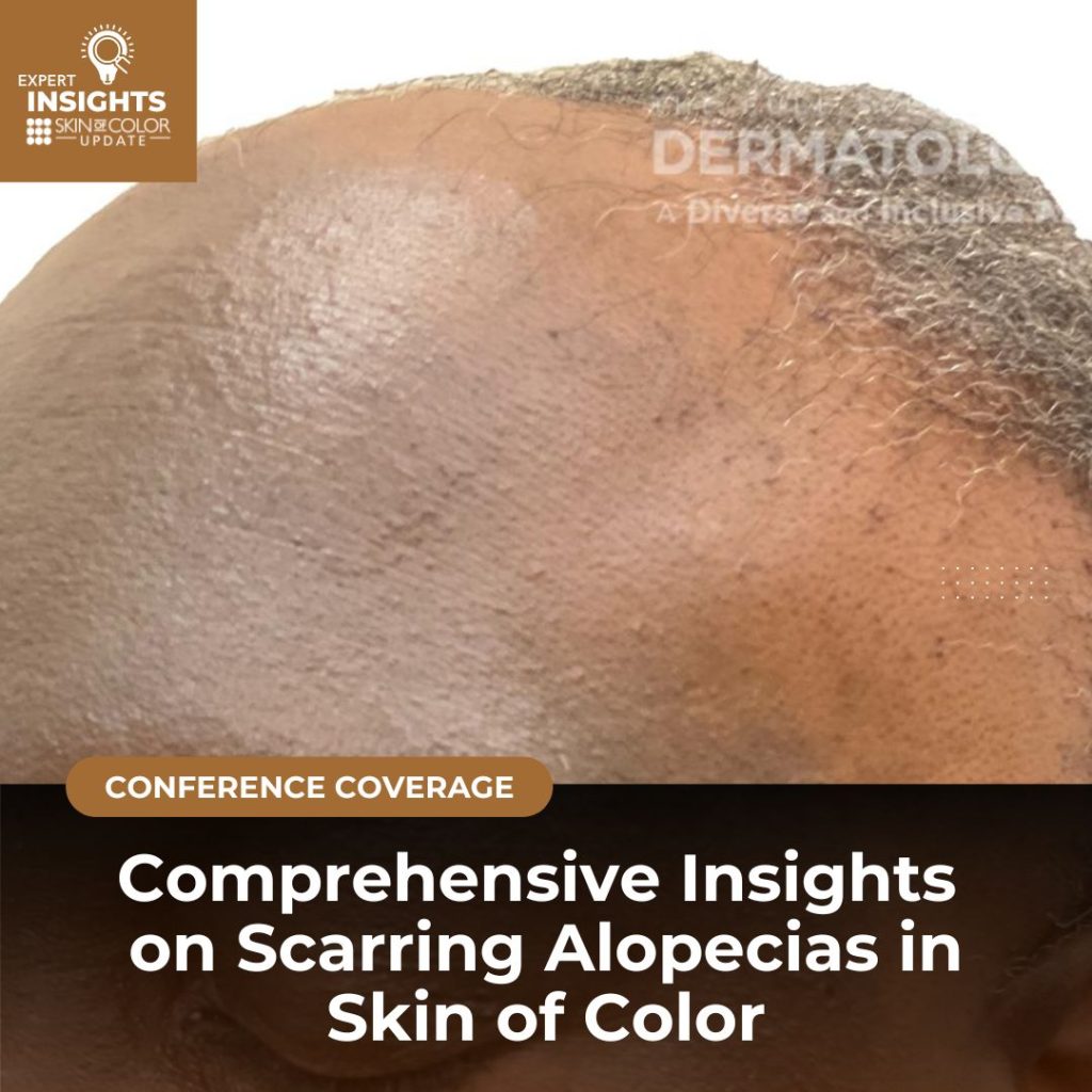 cicatricial alopecia diagnosis Archives - Next Steps in Dermatology