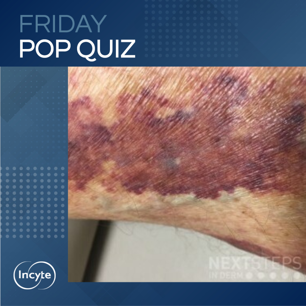 irregularly shaped macules Archives - Next Steps in Dermatology