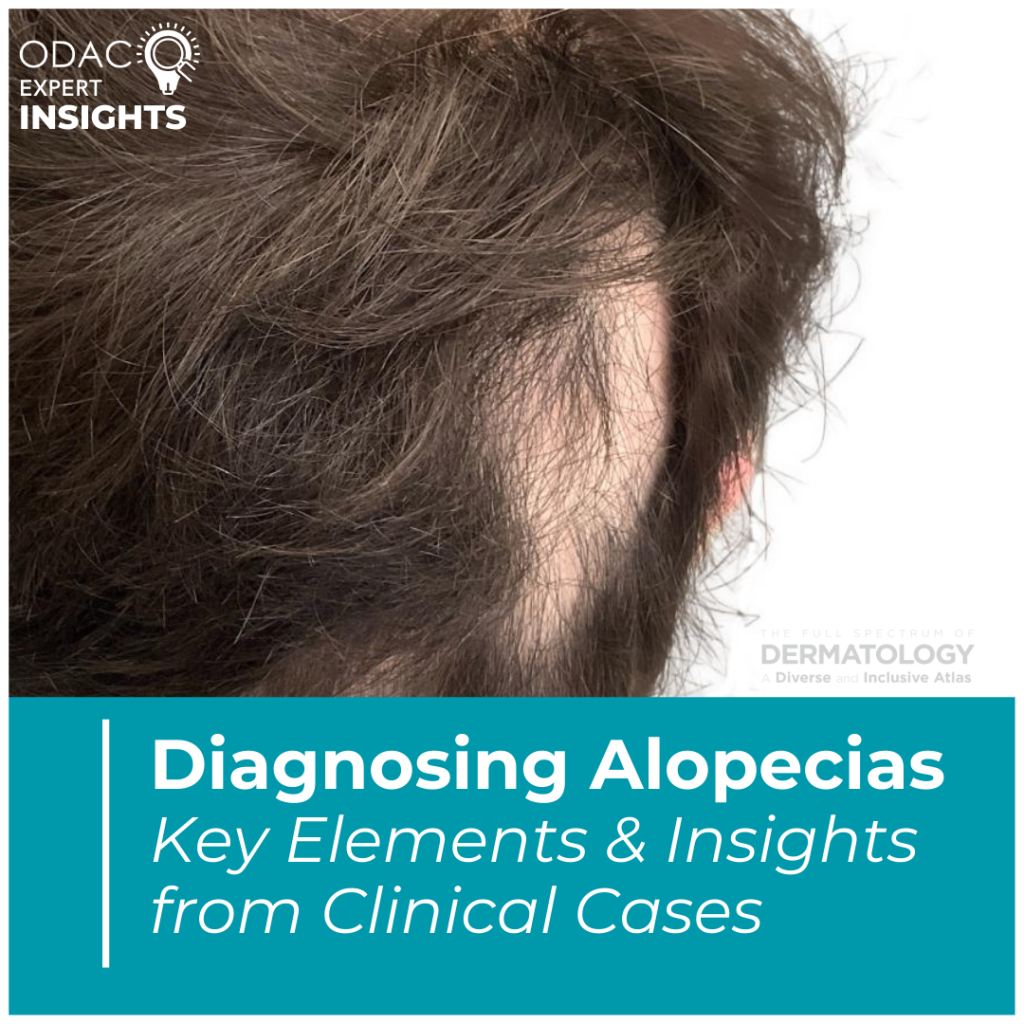 alopecia types Archives - Next Steps in Dermatology