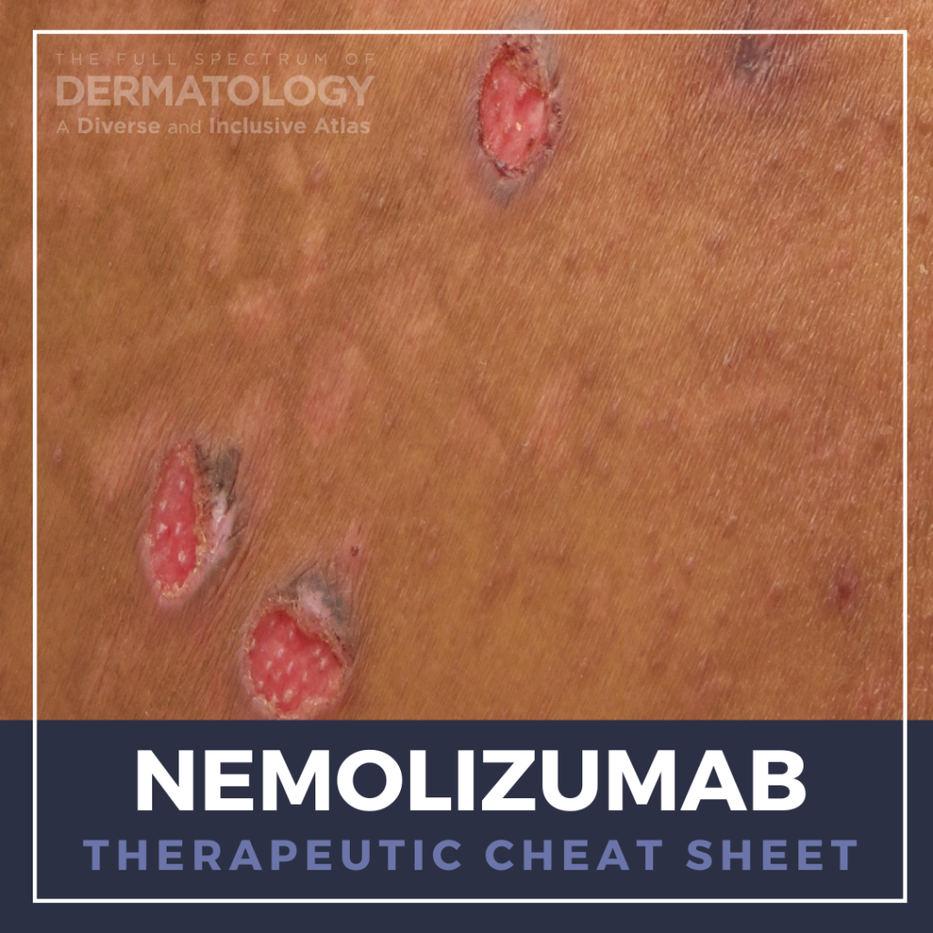 Nemolizumab Therapeutic Cheat Sheet - Next Steps in Dermatology