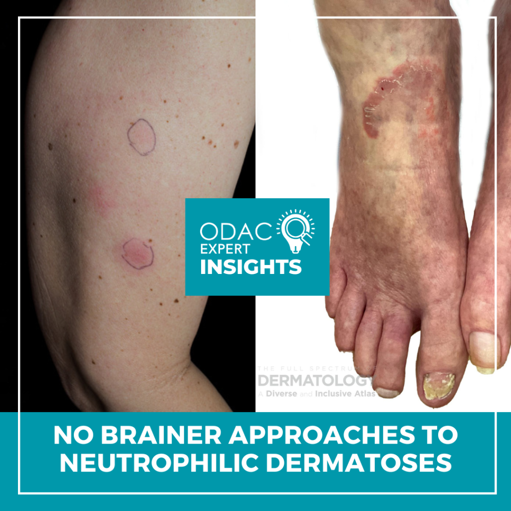 No Brainer Approaches to Neutrophilic Dermatoses - Next Steps in ...