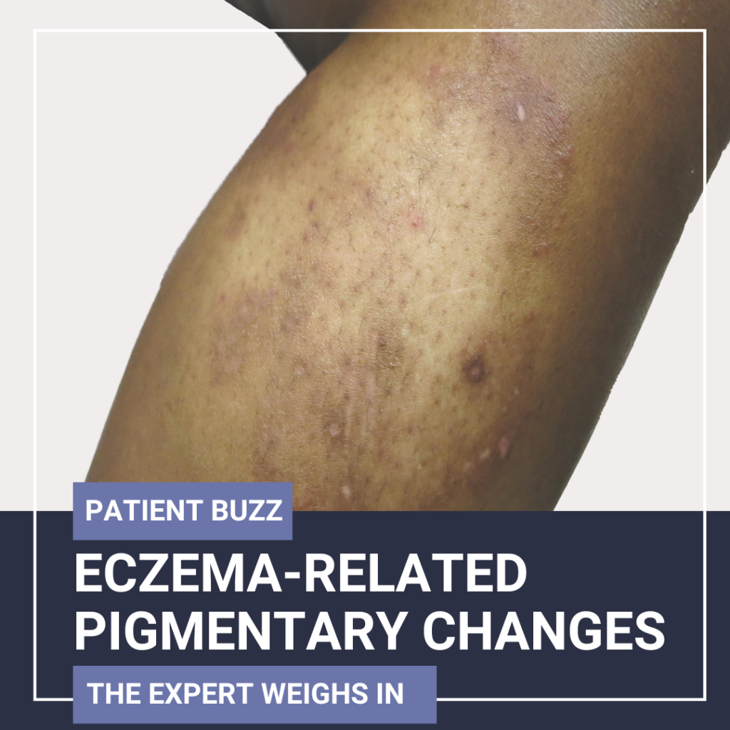 Patient Buzz: Eczema-Related Pigmentary Changes | The Expert Weighs In ...