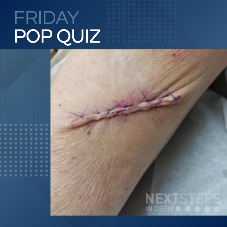 Horizontal mattress Archives - Next Steps in Dermatology