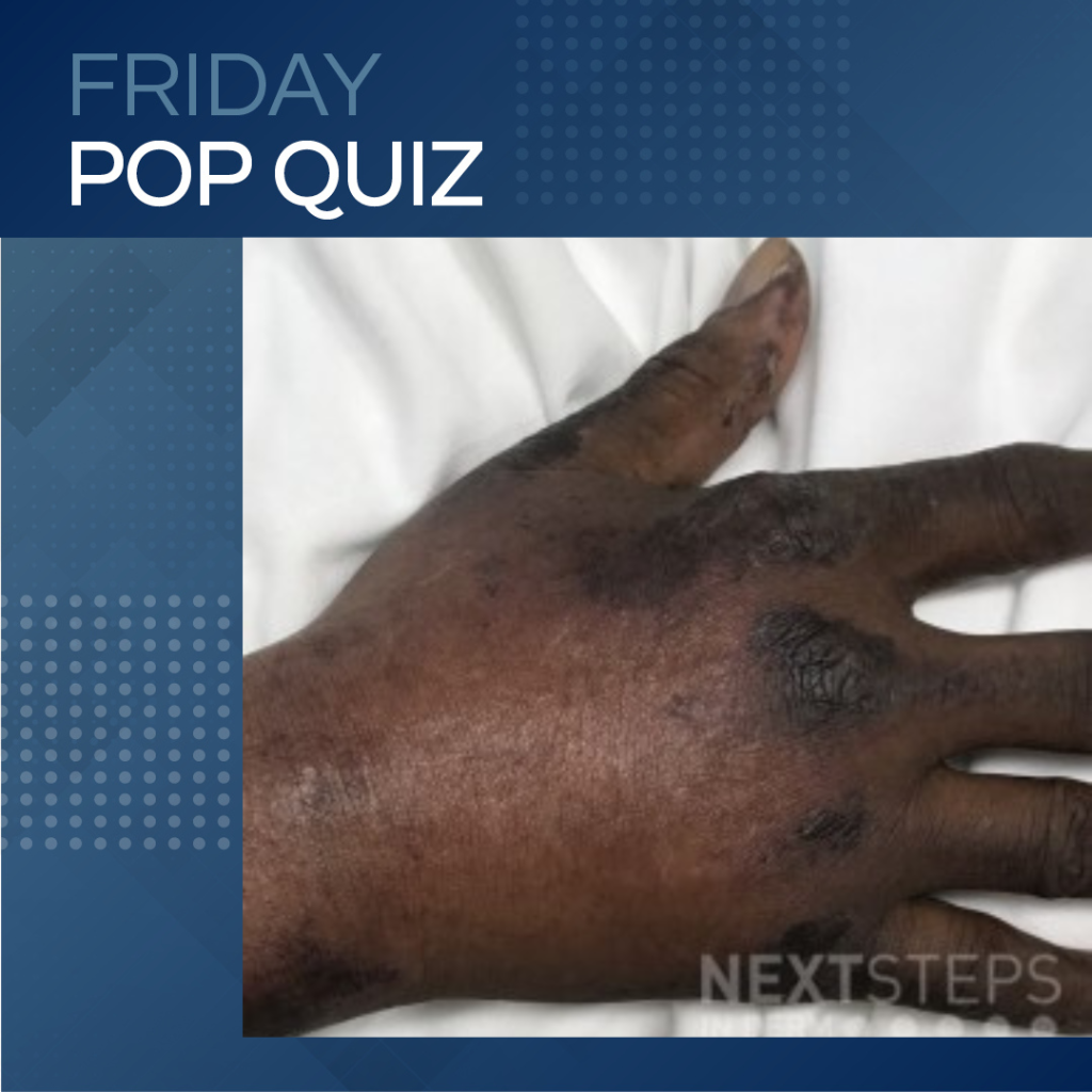 Gottron’s papules Archives - Next Steps in Dermatology