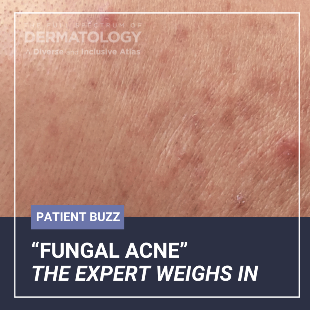 Patient Buzz: “Fungal Acne” | The Expert Weighs In - Next Steps in ...