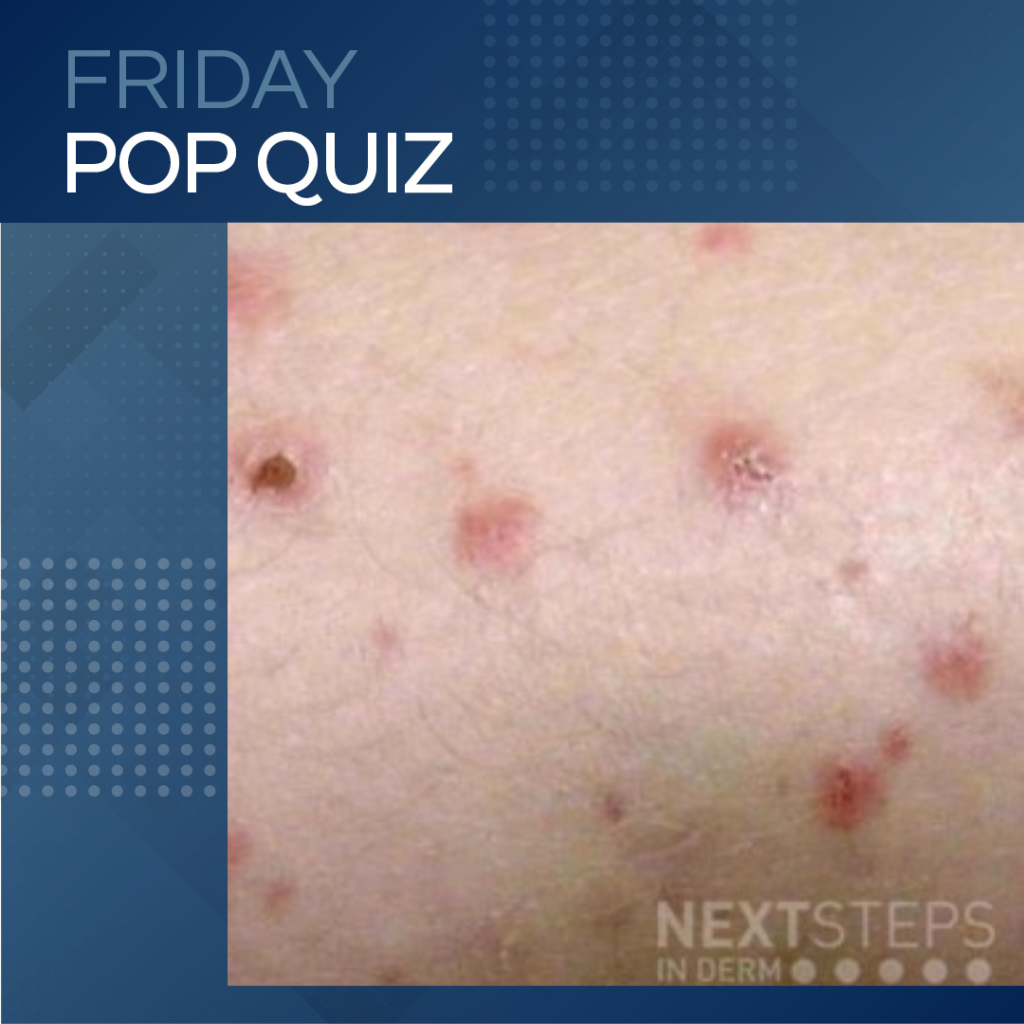 varioliform scarring Archives - Next Steps in Dermatology