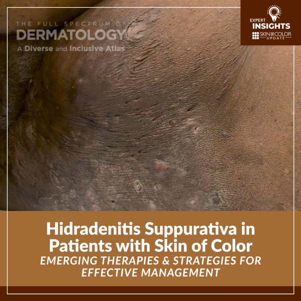 deroofing procedure for HS Archives - Next Steps in Dermatology